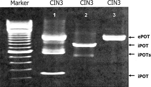 DNA Aneuploidy and Integration of Human Papillomavirus Type 16 E6/E7 ...