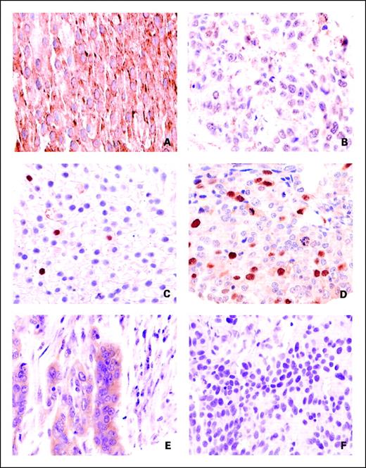 Bladder Cancer Outcome and Subtype Classification by Gene Expression ...