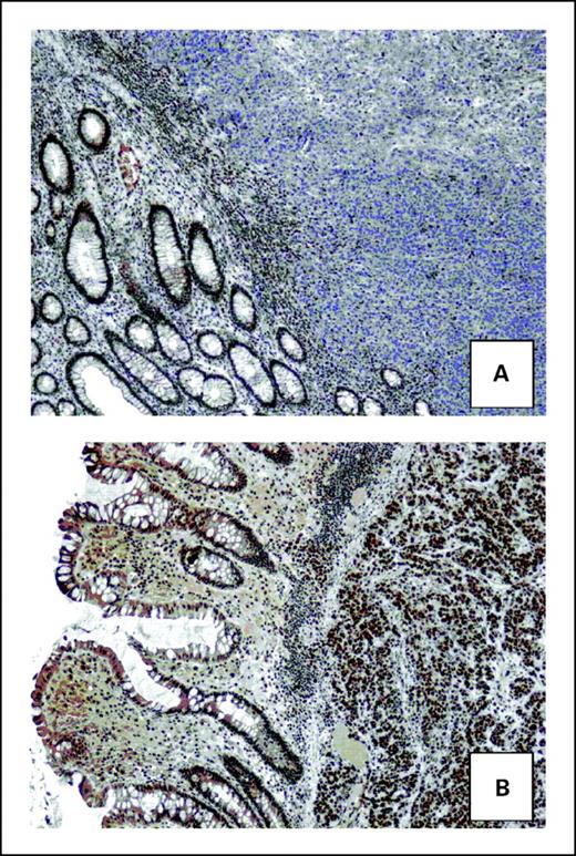 Isolated Loss of PMS2 Expression in Colorectal Cancers: Frequency ...
