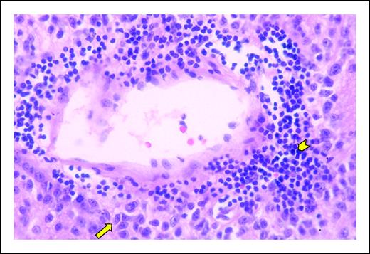Management of Central Nervous System Lymphomas Using Monoclonal ...