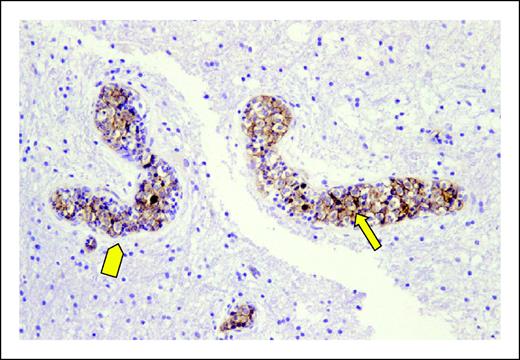 Management of Central Nervous System Lymphomas Using Monoclonal ...