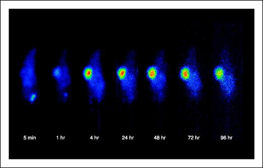 Pretargeting of Carcinoembryonic Antigen–Expressing Tumors with a ...