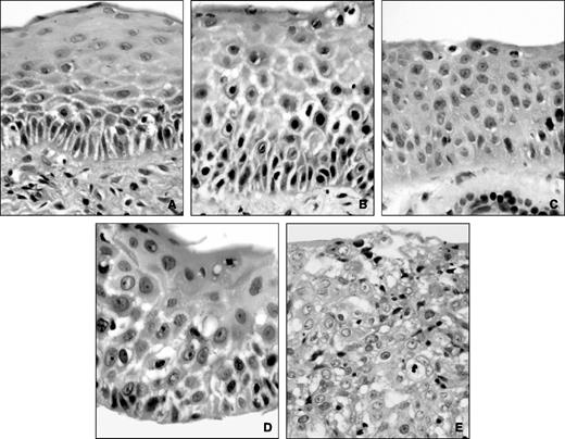 The Natural Course of Preneoplastic Lesions in Bronchial Epithelium ...