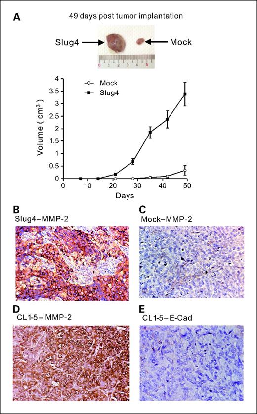 Transcription Repressor Slug Promotes Carcinoma Invasion and Predicts ...