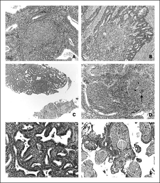 An Immunohistochemical Study of Morules in Endometrioid Lesions of the ...