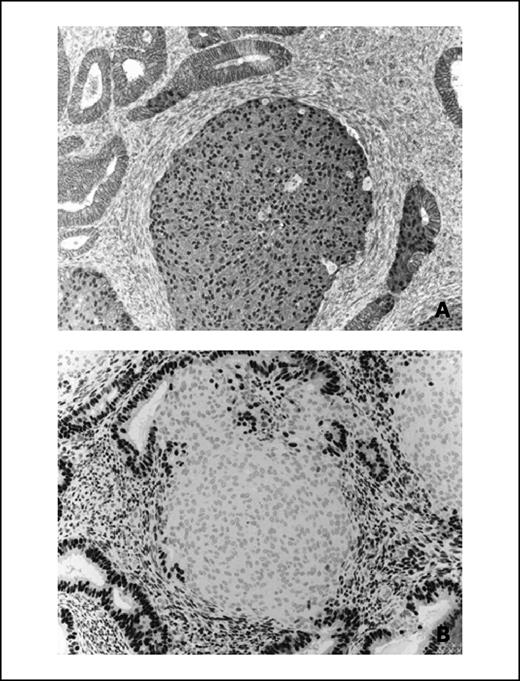 An Immunohistochemical Study of Morules in Endometrioid Lesions of the ...
