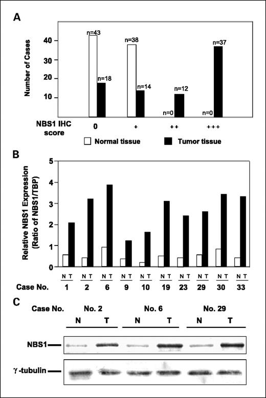 Increased NBS1 Expression Is a Marker of Aggressive Head and Neck ...