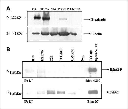 Expression of EphA2 and Ephrin A-1 in Carcinoma of the Urinary Bladder ...