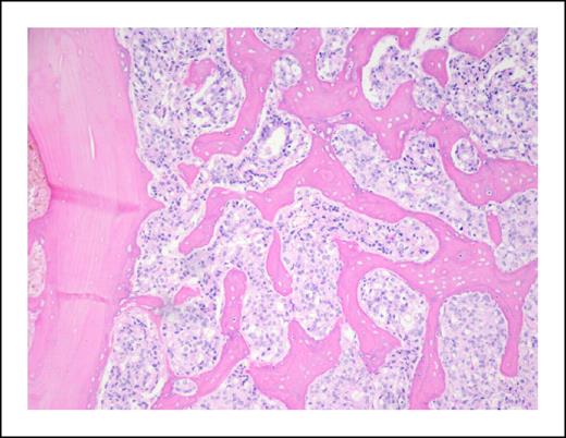 High-Linear Energy Transfer Irradiation Targeted to Skeletal Metastases ...