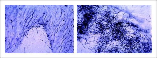 High-Linear Energy Transfer Irradiation Targeted to Skeletal Metastases ...