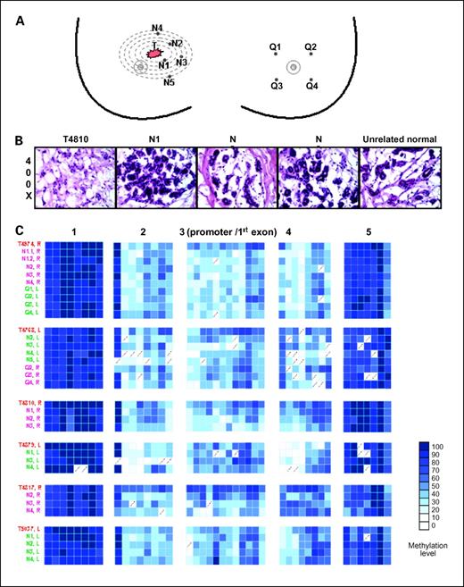 Mapping Geographic Zones of Cancer Risk with Epigenetic Biomarkers in Normal Breast Tissue ...