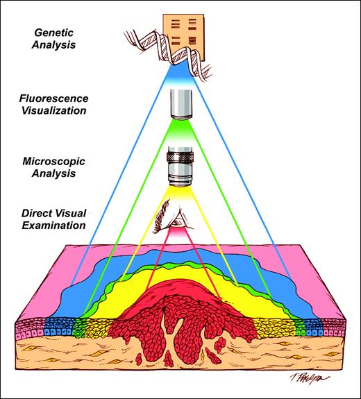 Fluorescence Visualization in Oral Neoplasia: Shedding Light on an Old ...