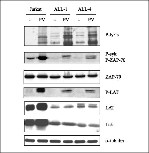 ZAP-70 Expression in Normal Pro/Pre B Cells, Mature B Cells, and in B ...