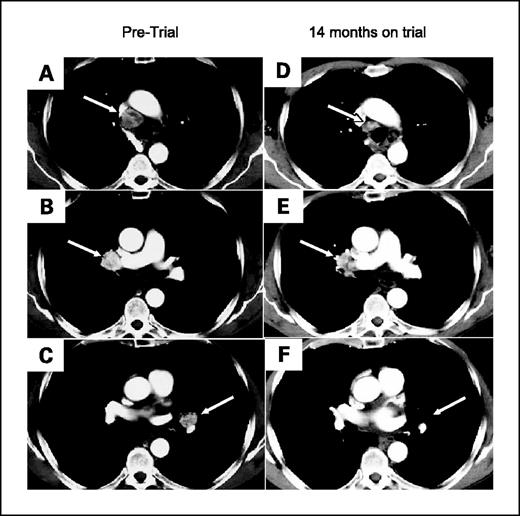 Mannan-MUC1–Pulsed Dendritic Cell Immunotherapy: A Phase I Trial in ...