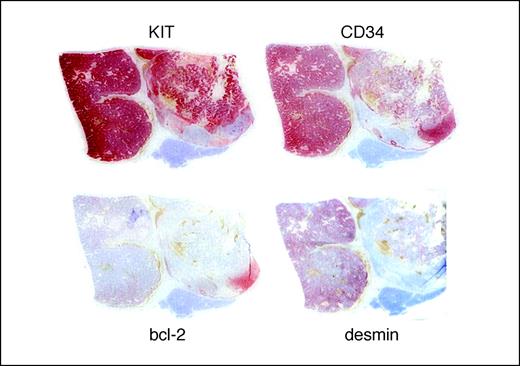 Polyclonal Evolution of Multiple Secondary KIT Mutations in ...