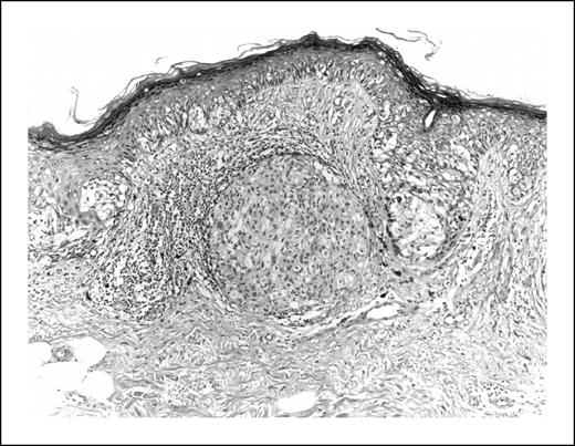 Pathology of Melanoma | Clinical Cancer Research | American Association ...