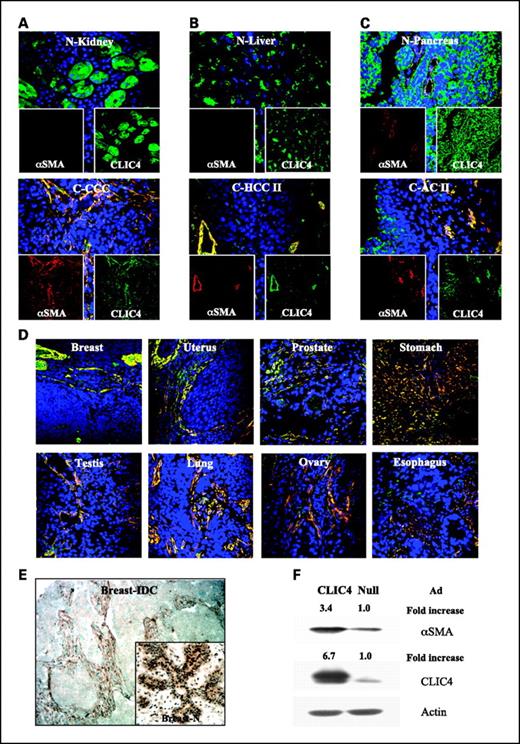 Reciprocal Modifications of CLIC4 in Tumor Epithelium and Stroma Mark ...