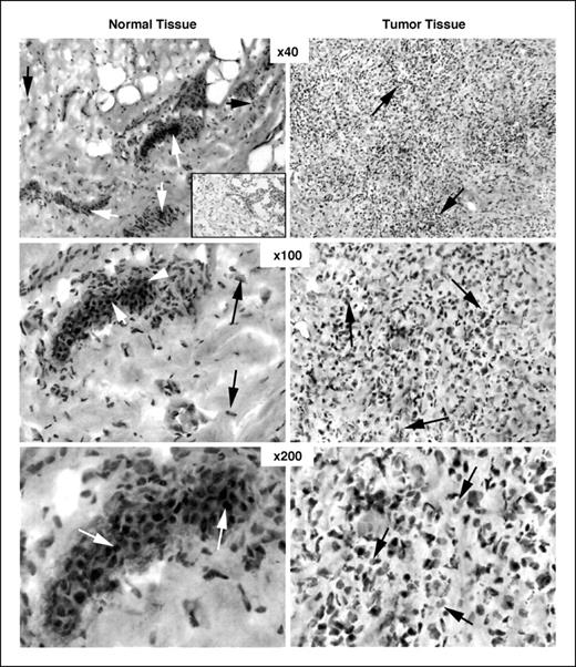 Matriptase-2 Inhibits Breast Tumor Growth and Invasion and Correlates ...
