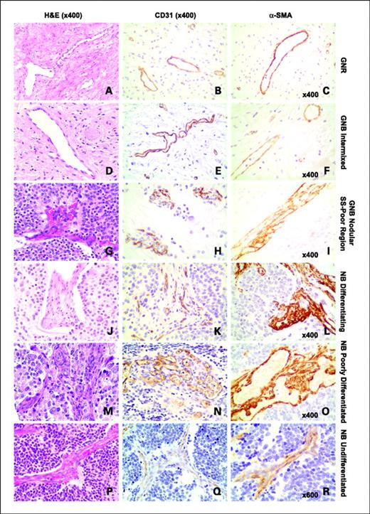 Prominent Microvascular Proliferation in Clinically Aggressive ...