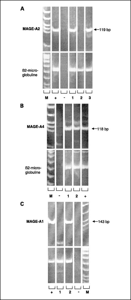 Detection of MAGE-A Transcripts in Bone Marrow Is an Independent ...