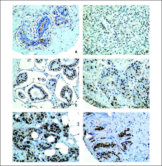 Foxa1 Expression In Breast Cancer—correlation With Luminal Subtype A