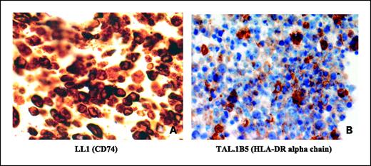 CD74: A New Candidate Target for the Immunotherapy of B-Cell Neoplasms ...