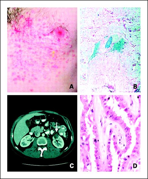 Identification of the Genes for Kidney Cancer: Opportunity for Disease ...