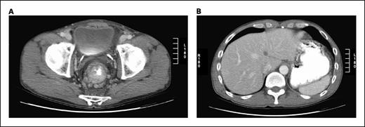 Optimal Methods for Staging Rectal Cancer | Clinical Cancer Research ...