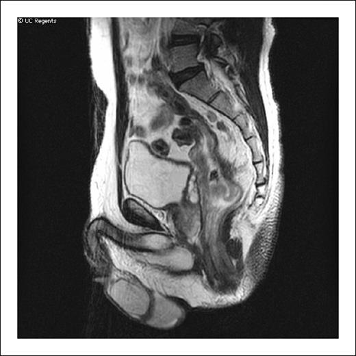 Optimal Methods for Staging Rectal Cancer | Clinical Cancer Research ...