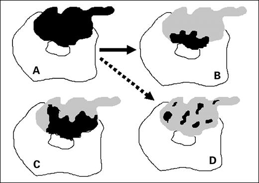 Circumferential Margin Involvement Is the Crucial Prognostic Factor ...