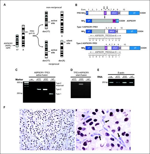 Angiogenesis-Promoting Gene Patterns in Alveolar Soft Part Sarcoma ...