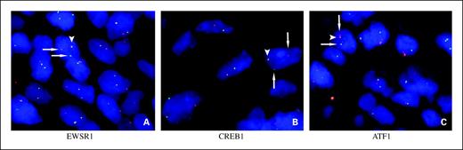 EWSR1-CREB1 and EWSR1-ATF1 Fusion Genes in Angiomatoid Fibrous ...
