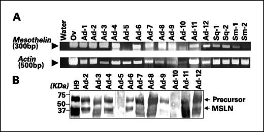 Mesothelin Expression in Human Lung Cancer | Clinical Cancer Research ...
