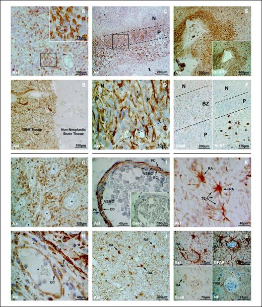 Axl and Growth Arrest–Specific Gene 6 Are Frequently Overexpressed in ...