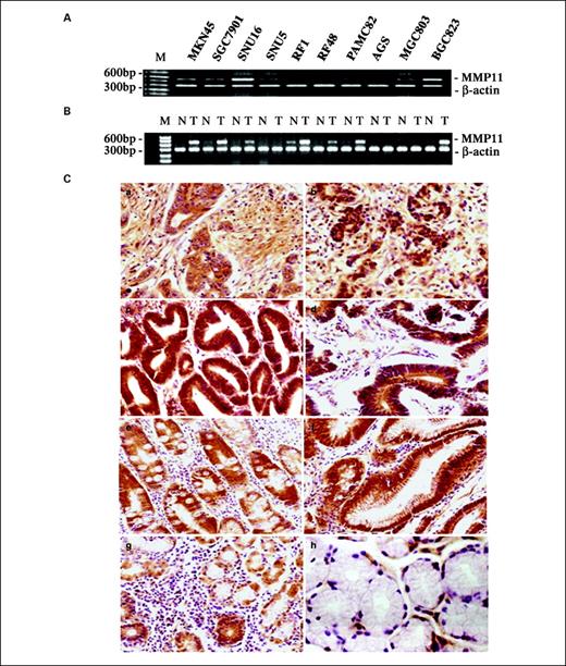 Identification of Matrix Metalloproteinase 11 as a Predictive Tumor ...