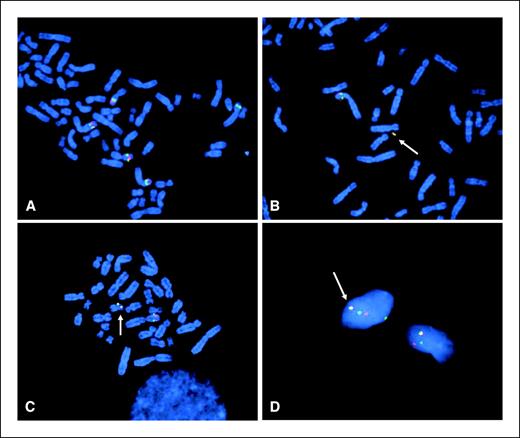 EML4-ALK Fusion Gene and Efficacy of an ALK Kinase Inhibitor in Lung ...