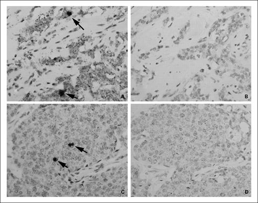 Prognostic Significance of CD55 Expression in Breast Cancer | Clinical ...