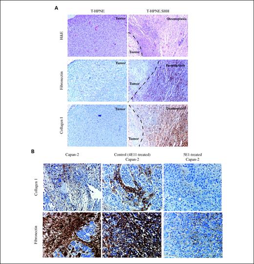 Sonic Hedgehog Promotes Desmoplasia in Pancreatic Cancer | Clinical ...