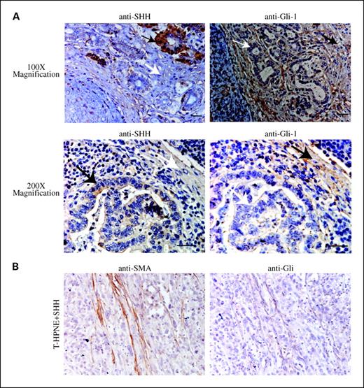 Sonic Hedgehog Promotes Desmoplasia in Pancreatic Cancer | Clinical ...