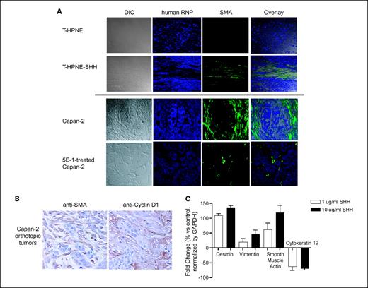 Sonic Hedgehog Promotes Desmoplasia in Pancreatic Cancer | Clinical ...