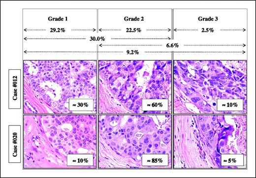 Ductal Carcinoma In situ and the Emergence of Diversity during Breast ...