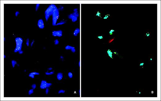 KIT Gene Mutations and Copy Number in Melanoma Subtypes | Clinical ...