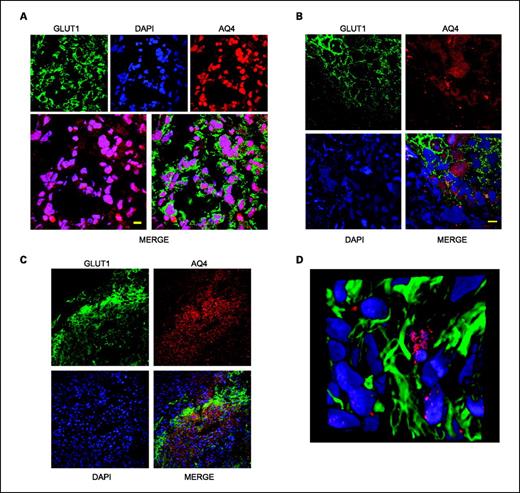 Hypoxia-Selective Targeting by the Bioreductive Prodrug AQ4N in ...