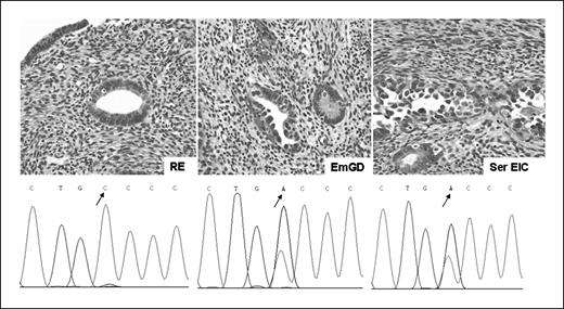 Endometrial Glandular Dysplasia with Frequent p53 Gene Mutation: A ...