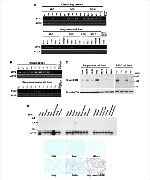 Involvement of Epithelial Cell Transforming Sequence-2 Oncoantigen in ...