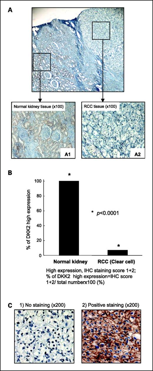 Wnt Antagonist Gene DKK2 Is Epigenetically Silenced and Inhibits Renal ...