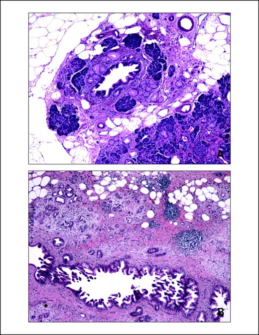 Increased Prevalence of Precursor Lesions in Familial Pancreatic Cancer ...