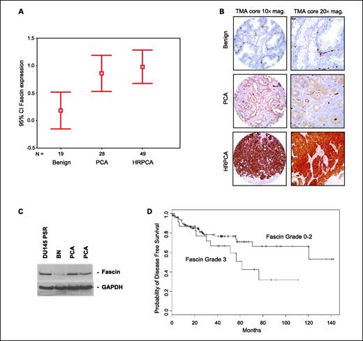 Fascin Regulates Prostate Cancer Cell Invasion and Is Associated with ...