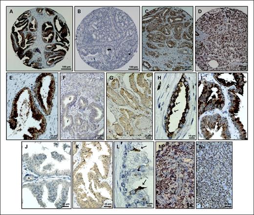 Genetic and Epigenetic SLC18A2 Silencing in Prostate Cancer Is an ...