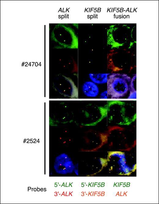 KIF5B-ALK, a Novel Fusion Oncokinase Identified by an ...